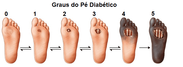 O que é e como funciona a classificação de Wagner?