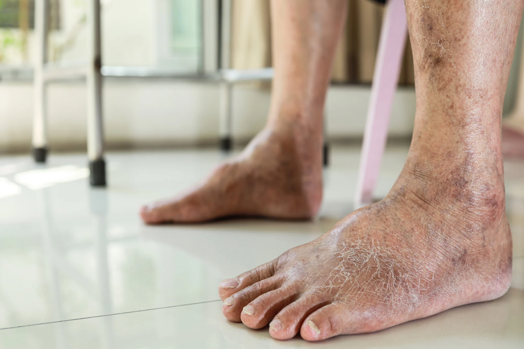 Você sabe o que é dermatite ocre?