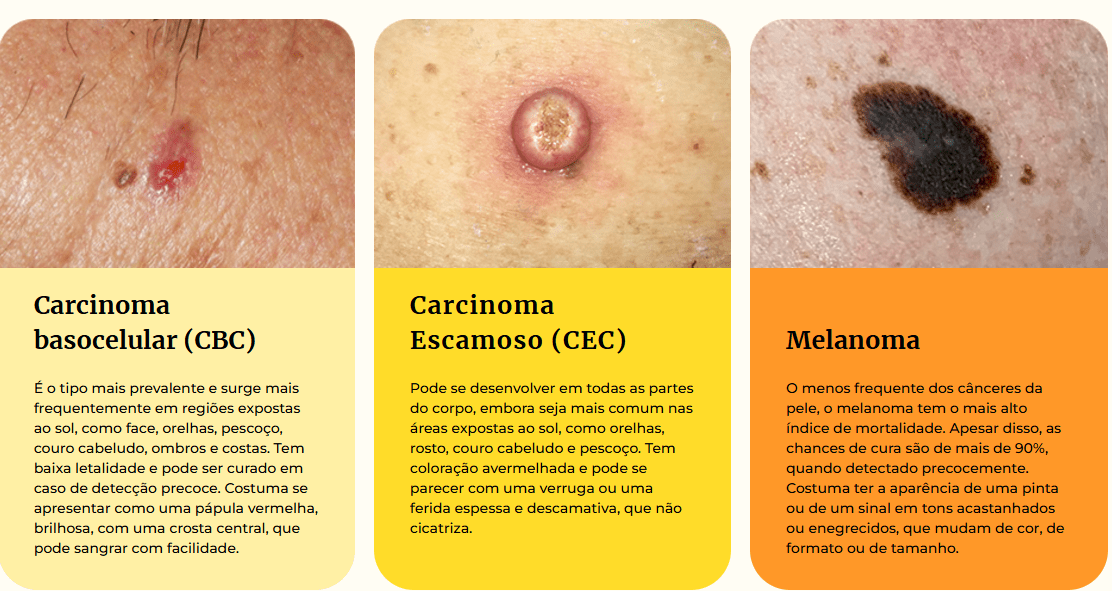 Tipos de Câncer de Pele: Sintomas, Diagnóstico e Tratamento – Vuelo Pharma