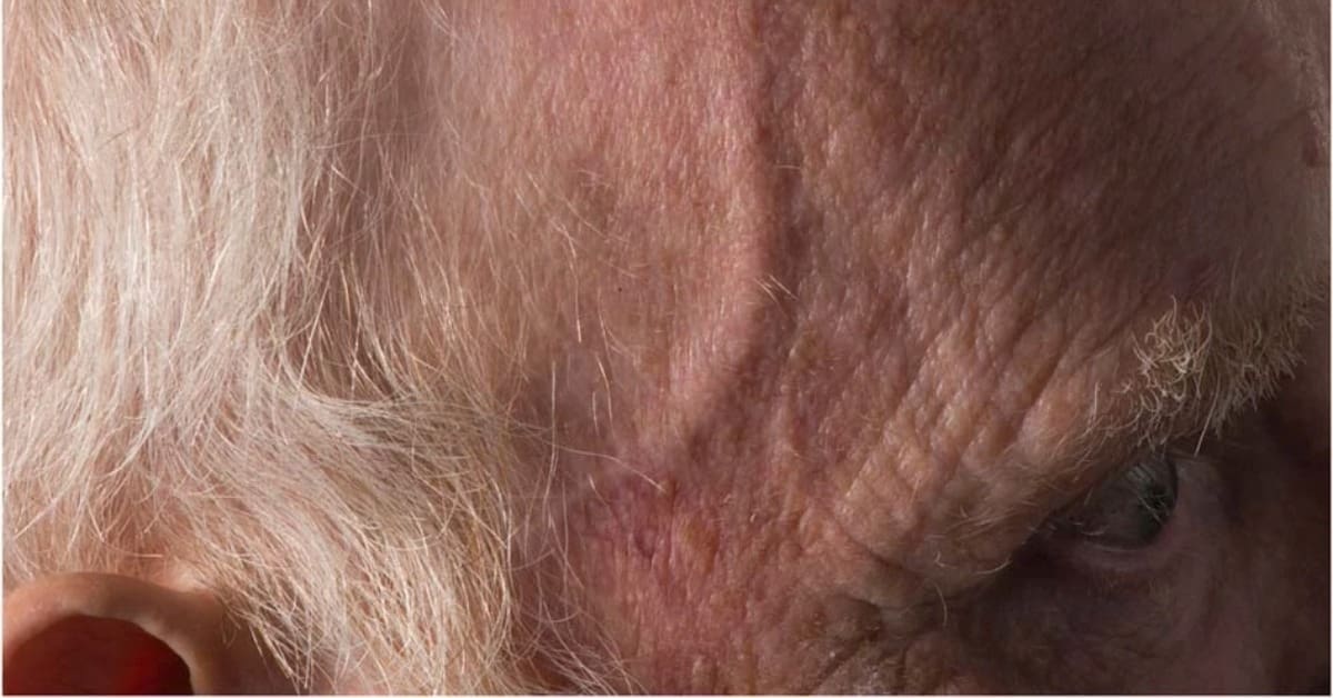 O que é vasculite cutânea | Vuelo Pharma